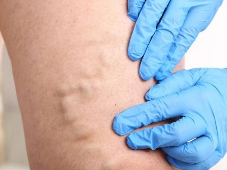 LASERSKA OPERACIJA VENA (EVLA) - VS Clinic and Beauty